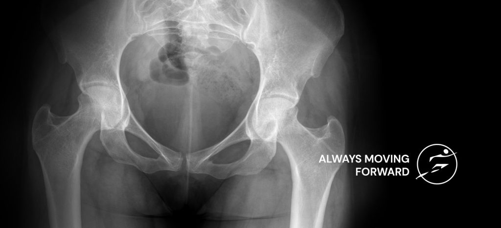 Avascular Necrosis HIP, Key Points of Avascular Necrosis, ArthrosClinic